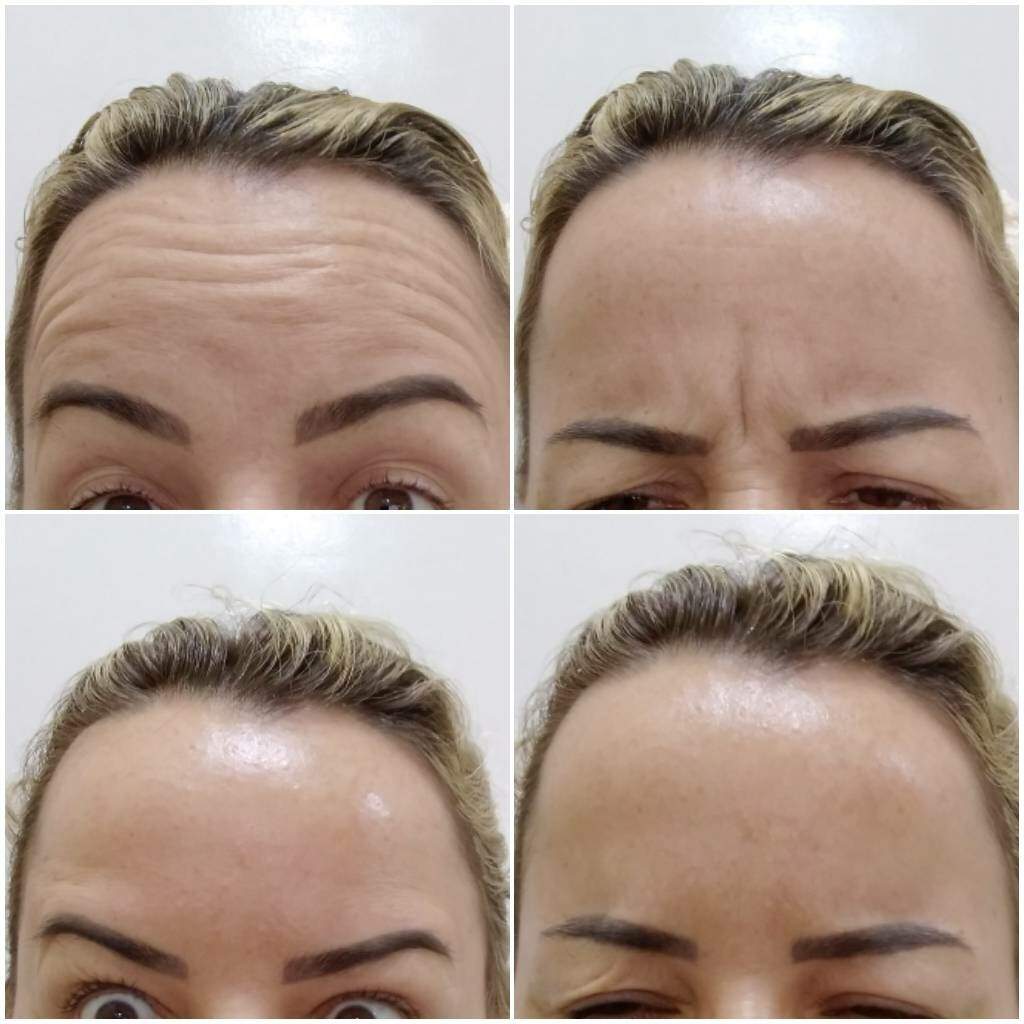"Semana do Botox" Royal Face deixa rosto lindo a partir de R$ 65 ...