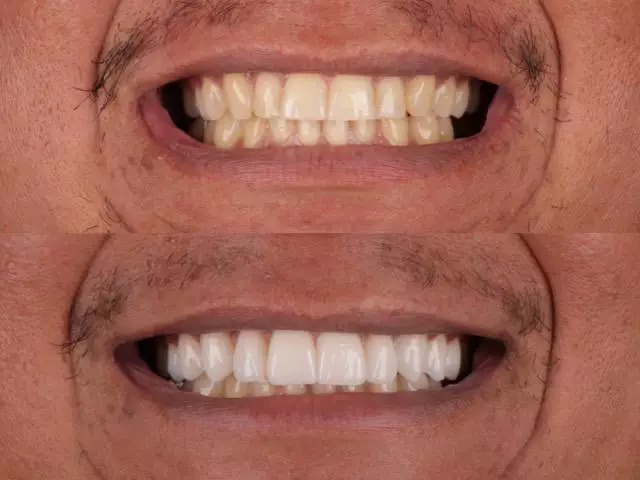 Harmonia entre face, lábios, dentes e gengiva cria sorriso perfeito ...