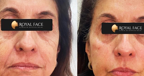 Com 1ª avaliação gratuita, Royal Face é líder em harmonização facial