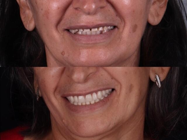 Sofrendo sem dentes? Veja como retomar a alegria de sorrir - Dr Diogo ...