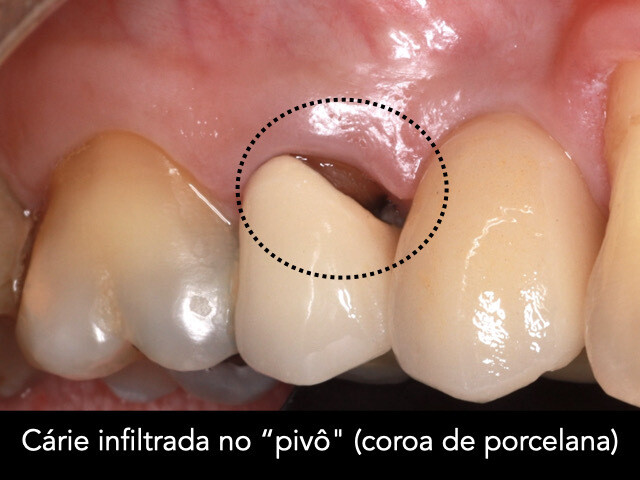 Cárie não é brincadeira e pode levar à perda dos dentes, entenda tudo ...