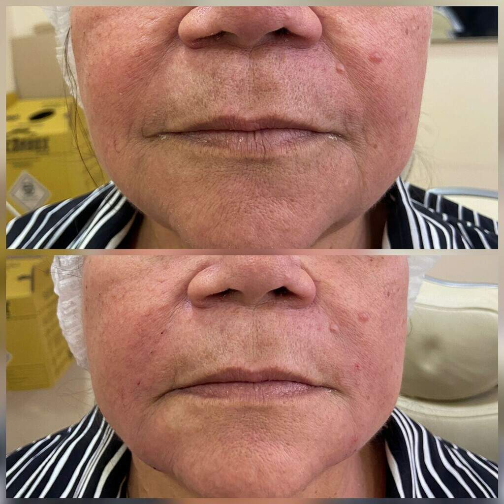 Royal Face tem novidade agora em Ultraformer e Botox day