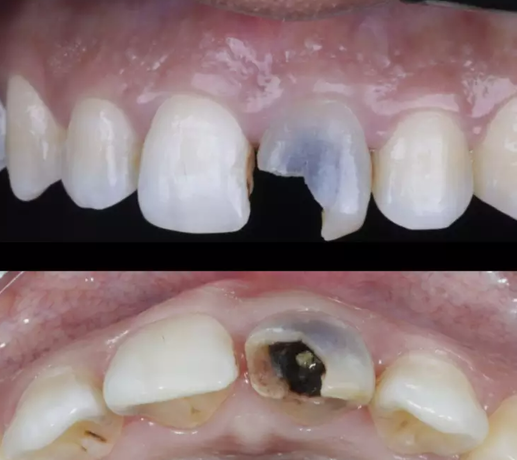 Está com cárie? Cuidado, você pode perder seus dentes