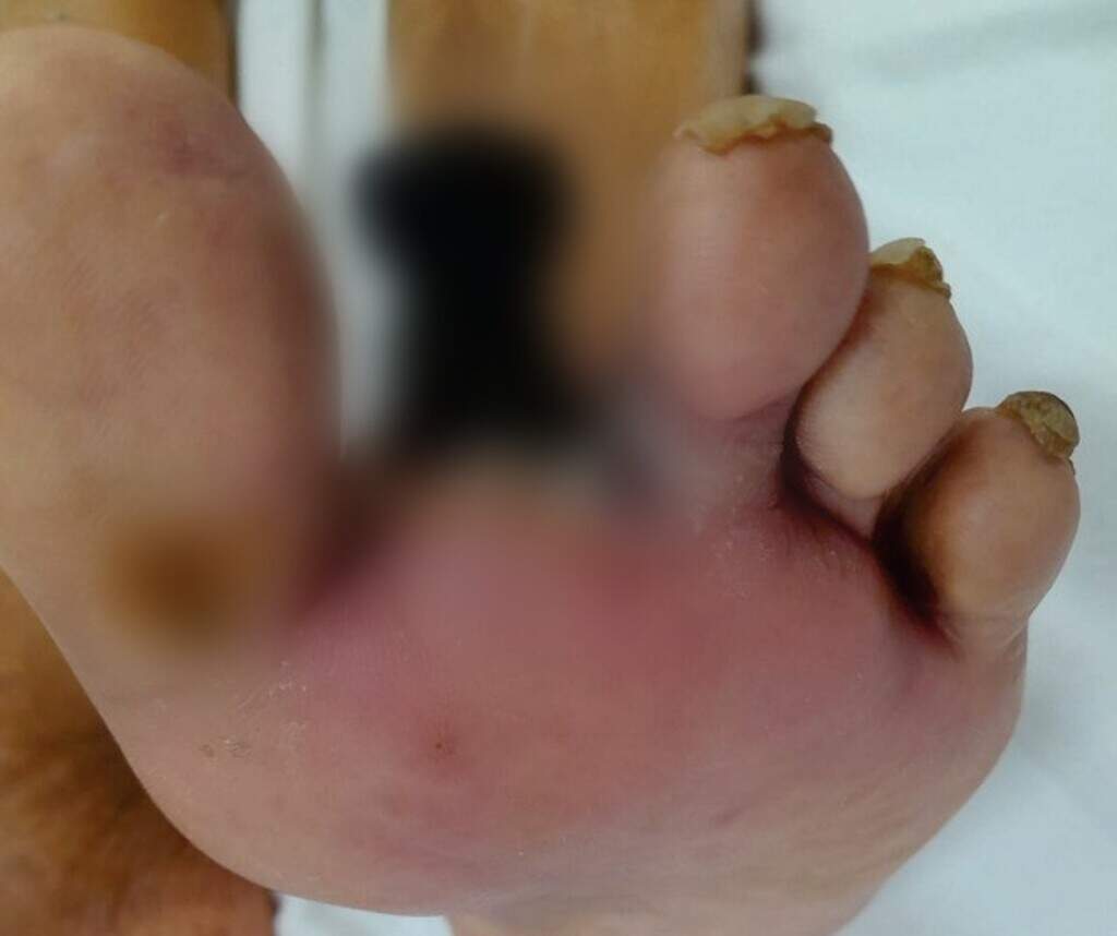 Idoso com pé necrosado consegue liminar para atendimento urgente em ...